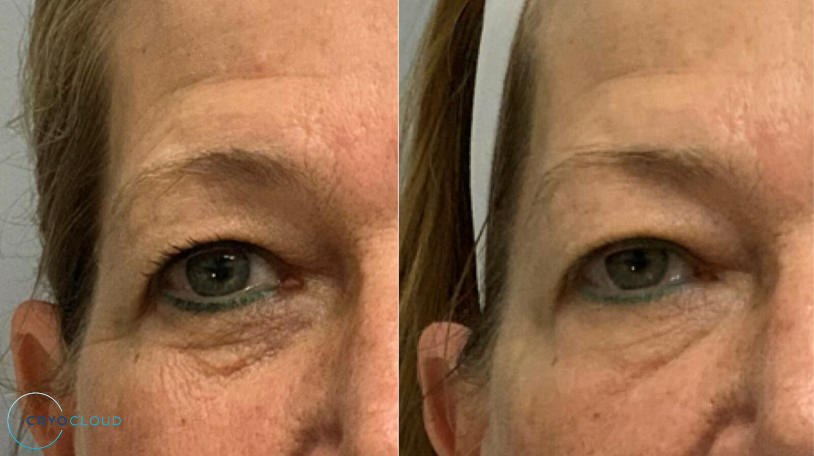 Cryo T-Shock Facial - Cryo Cloud, LLC.